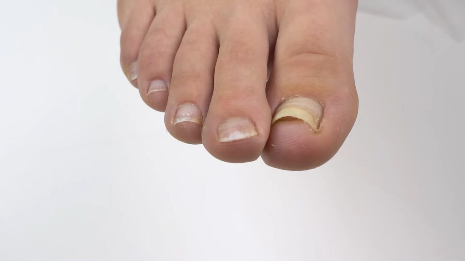 Can I Get a Pedicure with a Broken Toenail? Understanding Safe Nail ...
